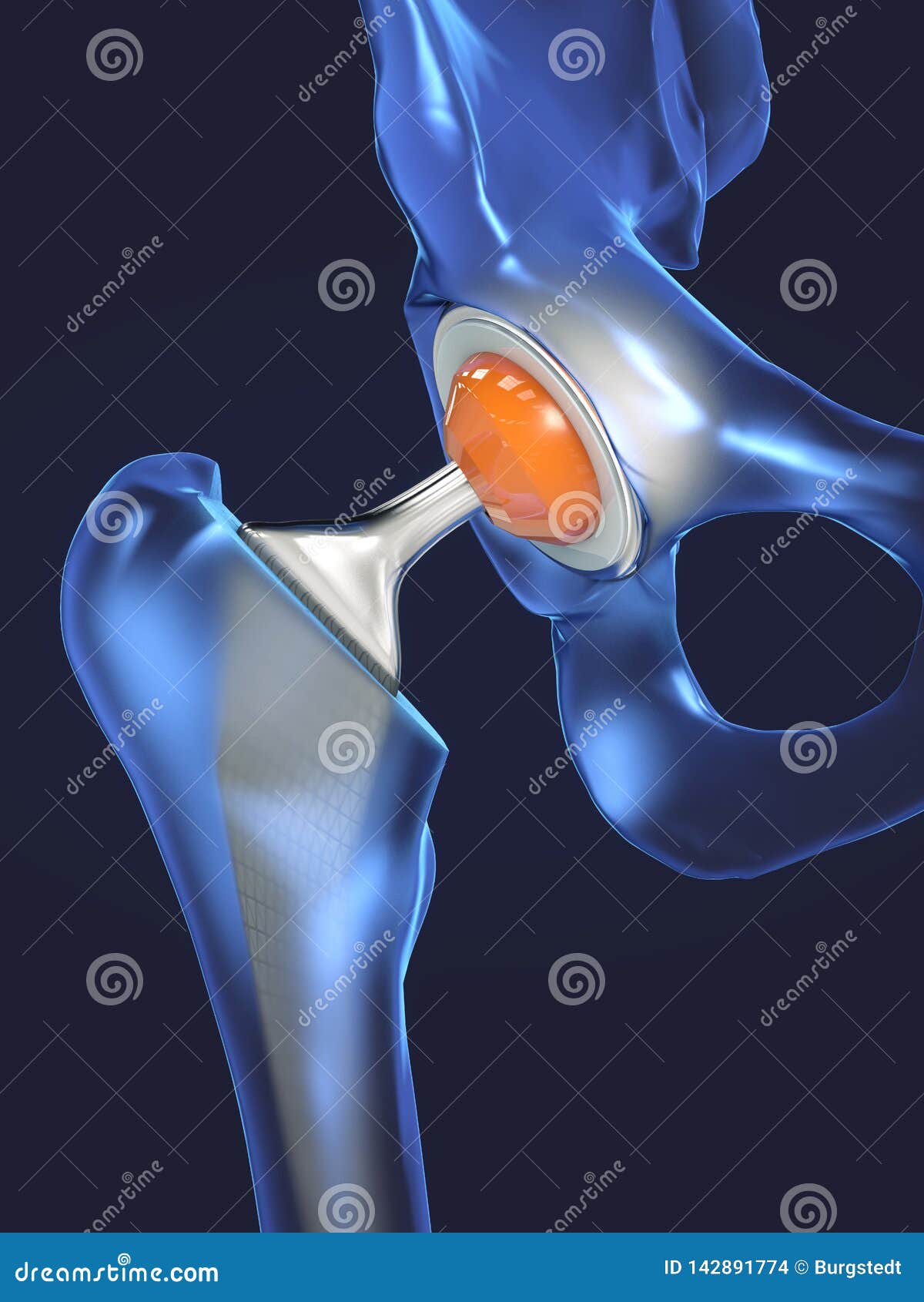 Function of a Hip Joint Implant or Hip Prosthesis in Frontal View Stock ...