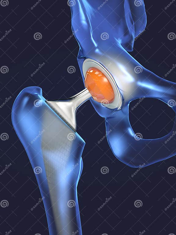 Function of a Hip Joint Implant or Hip Prosthesis in Frontal View Stock ...