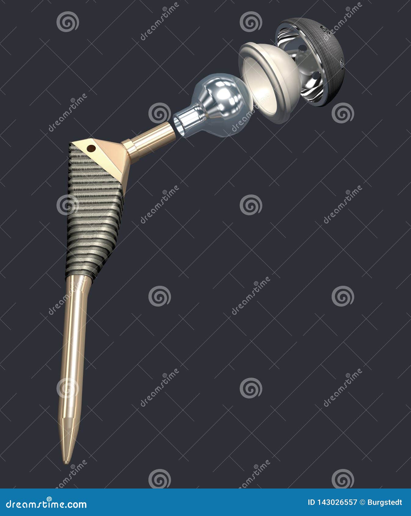 Function of a Hip Joint Implant or Hip Prosthesis in Frontal View Stock ...