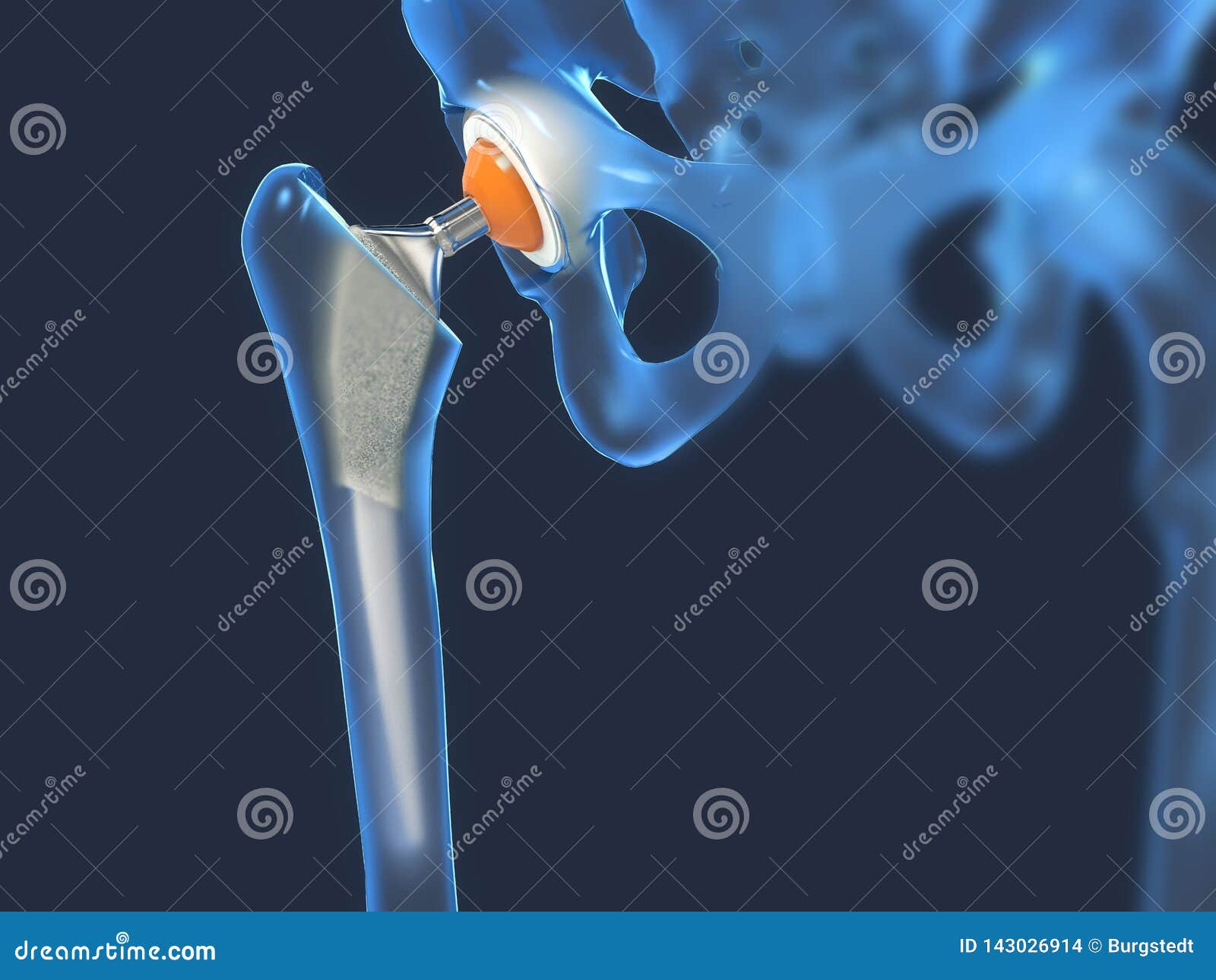 Function of a Hip Joint Implant or Hip Prosthesis in Frontal View Stock ...