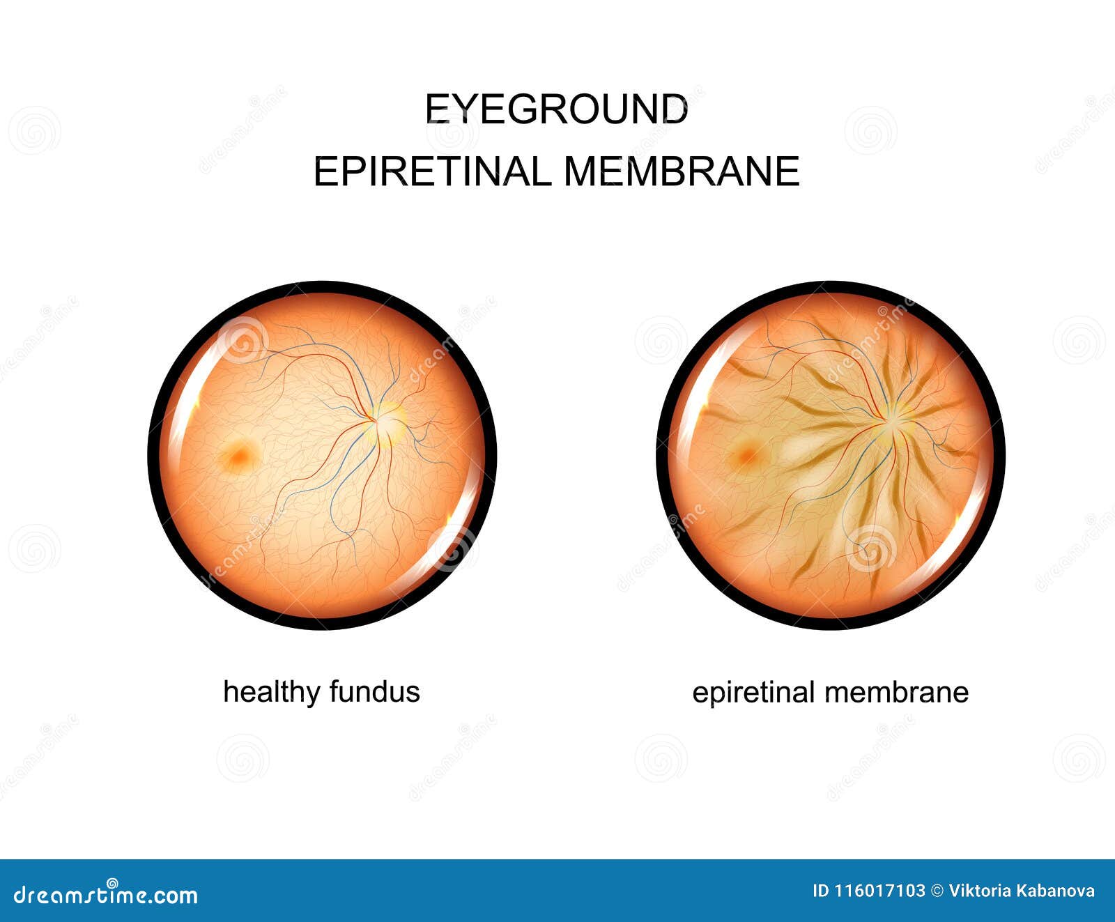 Fundus. Epiretinal Membrane Stock Vector - Illustration of eyeground ...