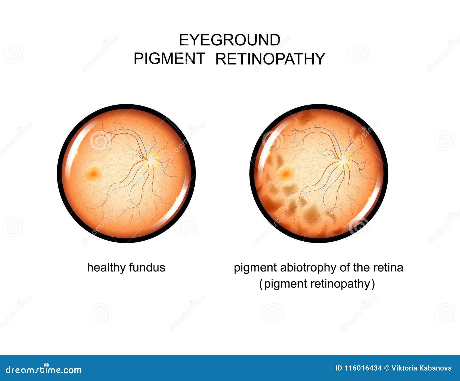 Fundus. Pigment Retinopathy Stock Vector - Illustration of eyeball ...
