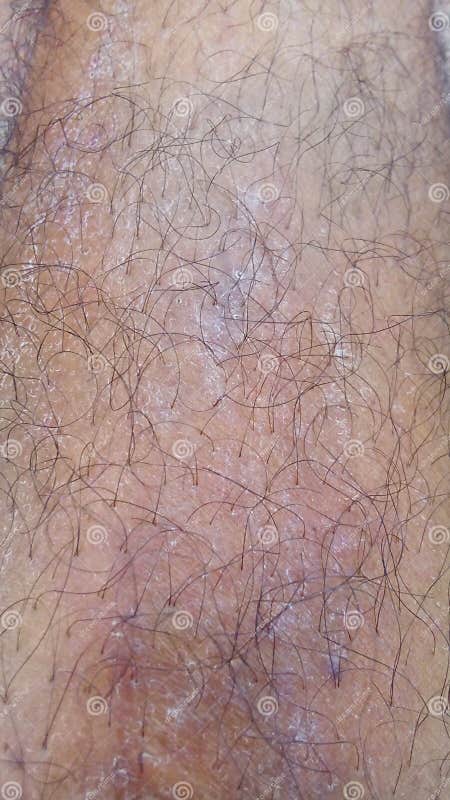 Fungal Infection on Leg Skin Stock Image - Image of health, ringworm ...