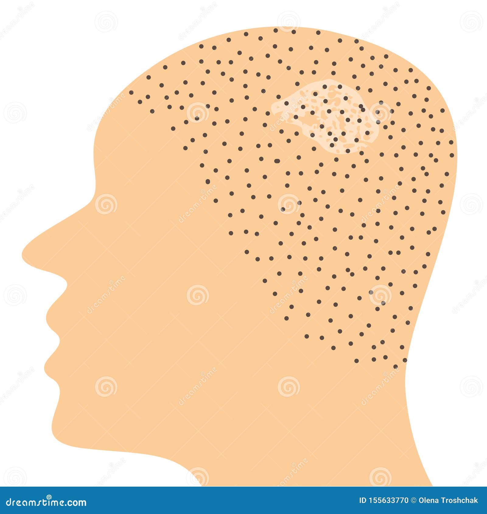 Fungal infection on scalp stock vector. Illustration of itchy - 155633770