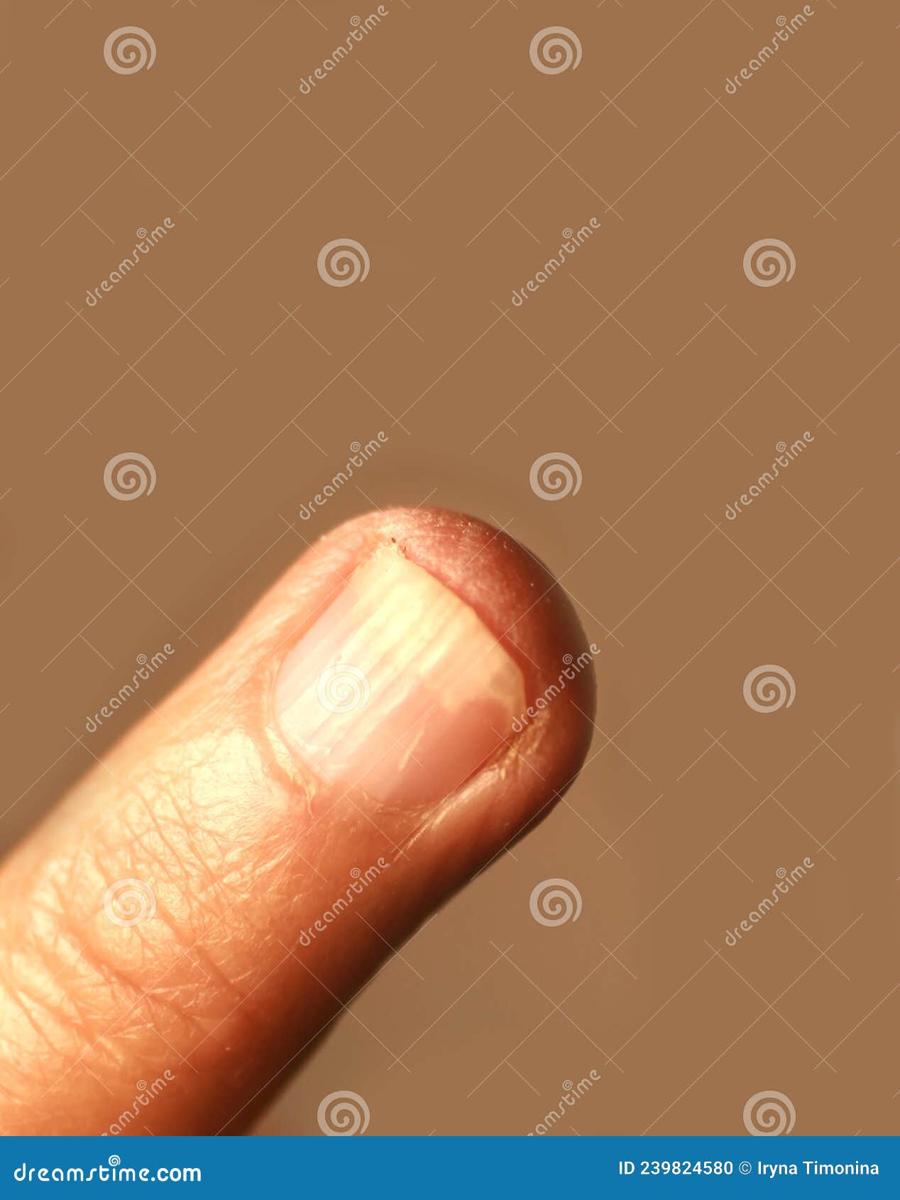 Fungal Infection Under the Nail. a Finger on a Hand with a Fungal ...
