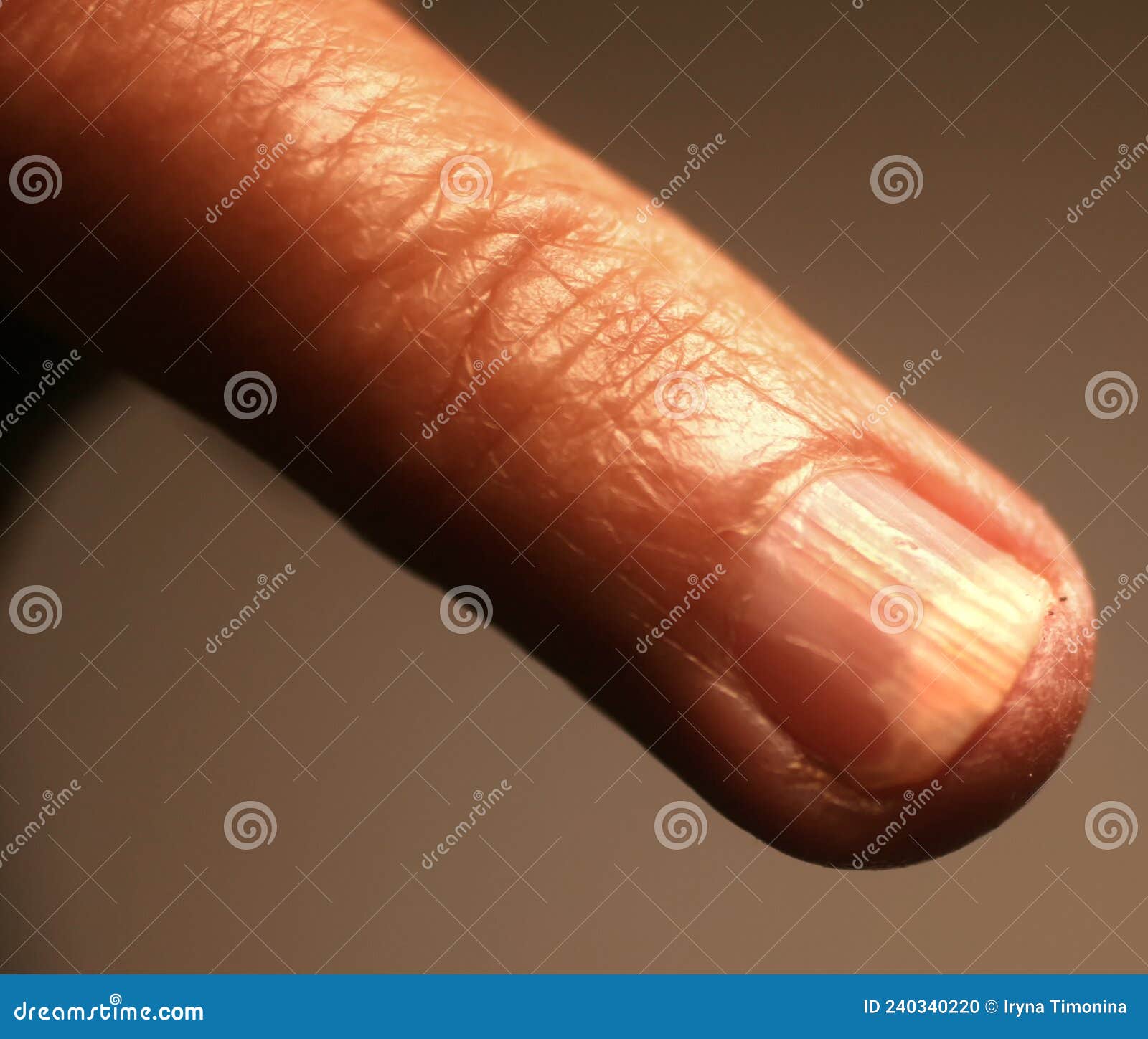 Fungal Infection On Finger Tips