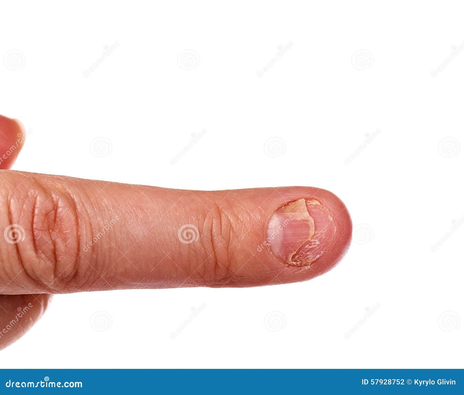Fungal Nail Infection and Damage Stock Photo - Image of person, nail ...