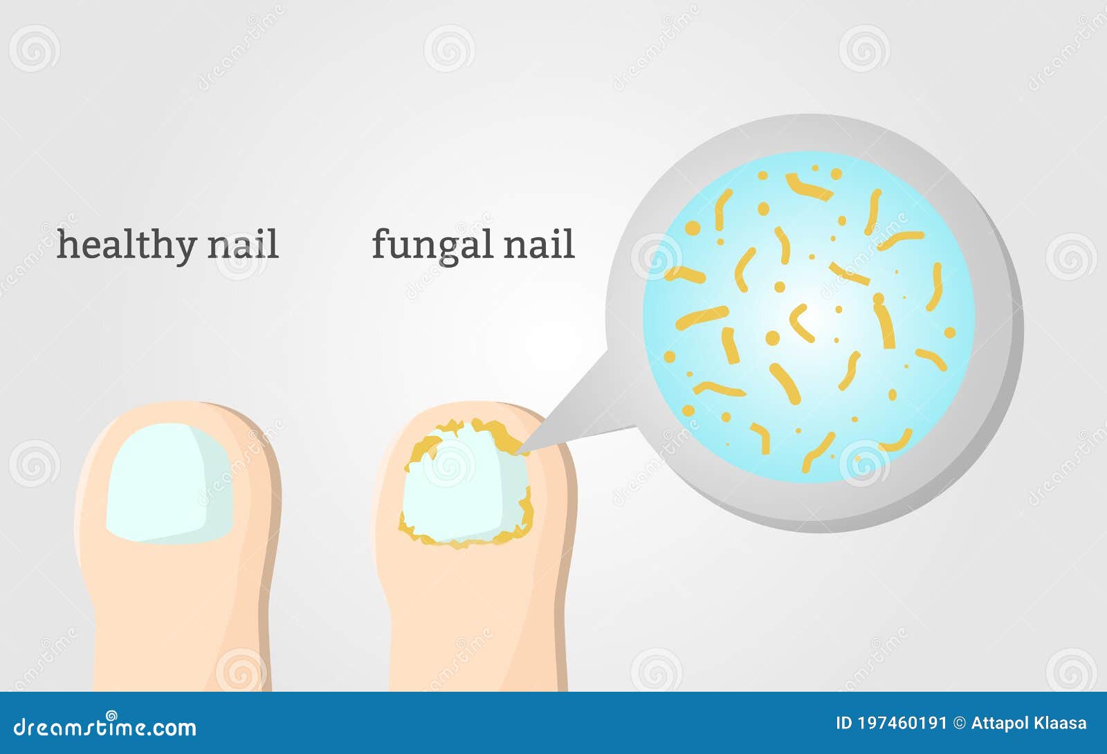 Fungal Nail Infection and Healthy Nail Disease or Beauty Problem on the ...