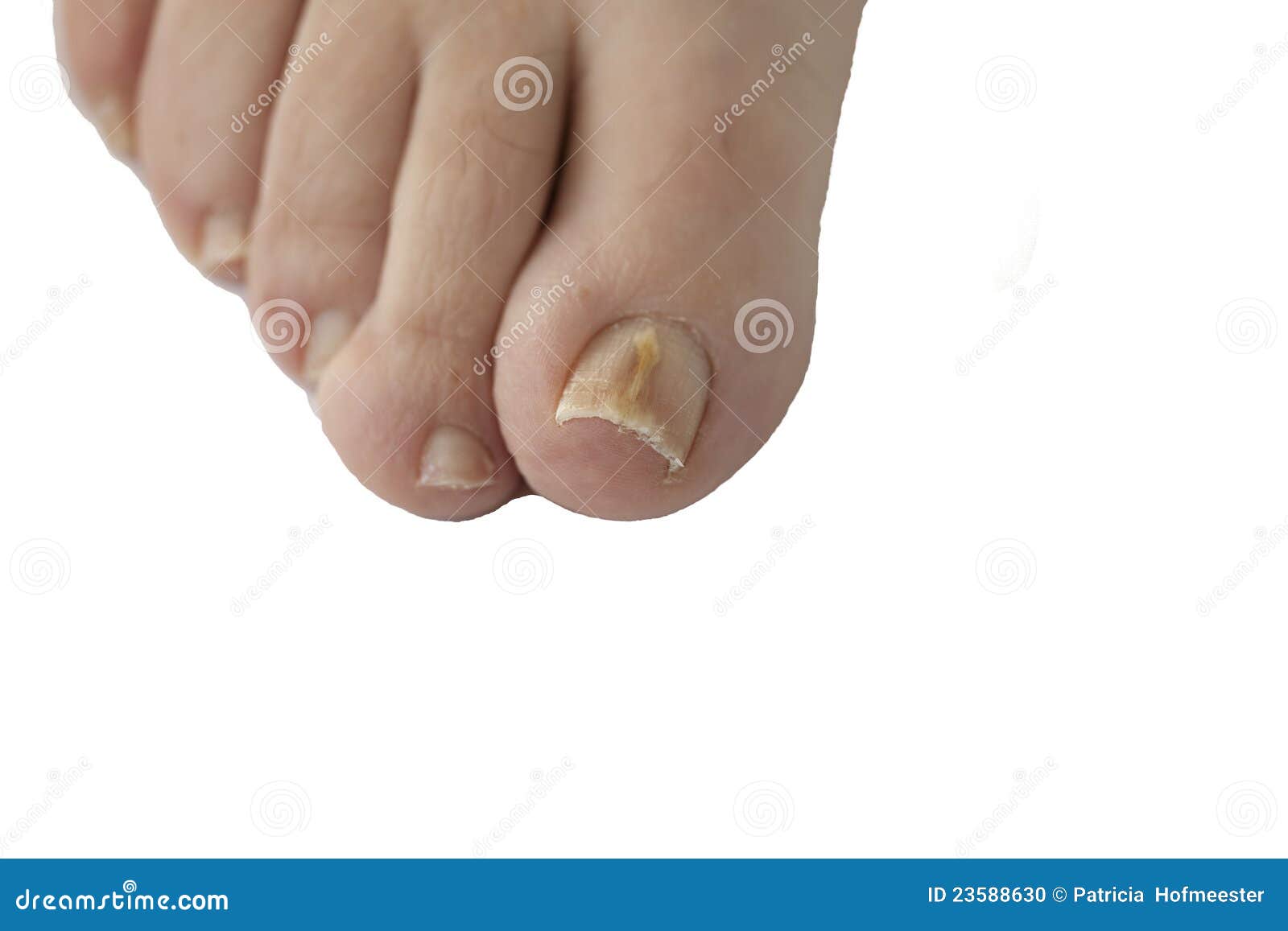 Fungal Nail Infection Isolated Stock Photo - Image of bacteria, painful ...