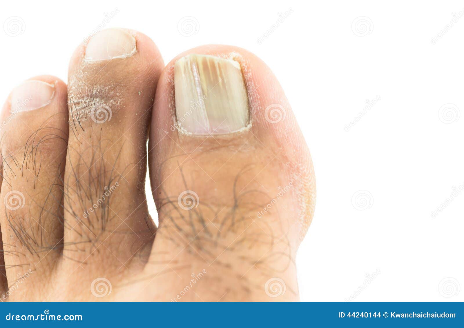 Funghi All'unghia Del Piede Fotografia Stock - Immagine di macro ...