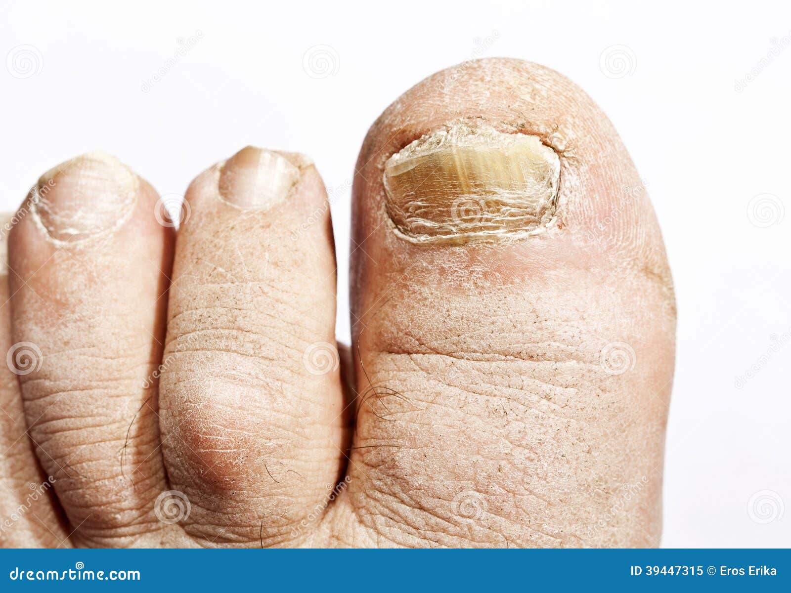Fungus Infection On Nails Hand, Finger With Onychomycosis. - Soft Focus ...