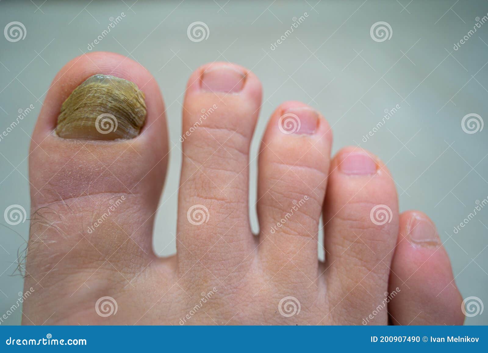 Fungus on a Man`s Big Toe. Close-up of a Nail Stock Photo - Image of ...