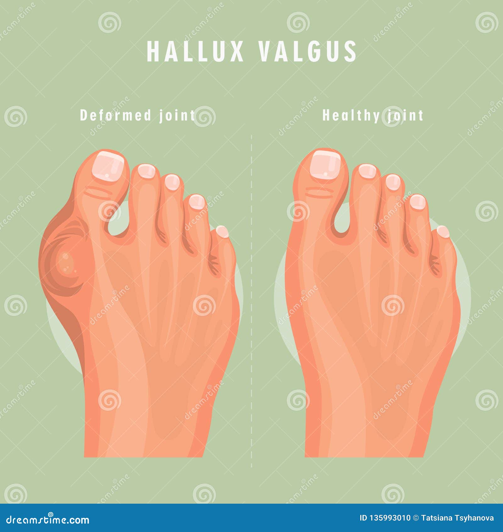 Hallux Valgus Vector Medicine Template. Stock Vector - Illustration of ...