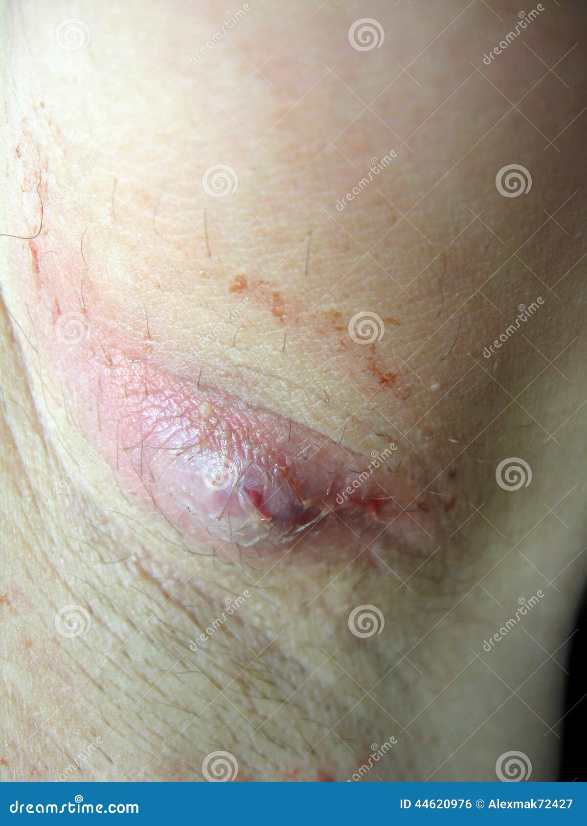 Furuncle Gathering Under the Armpit Stock Photo - Image of gather ...