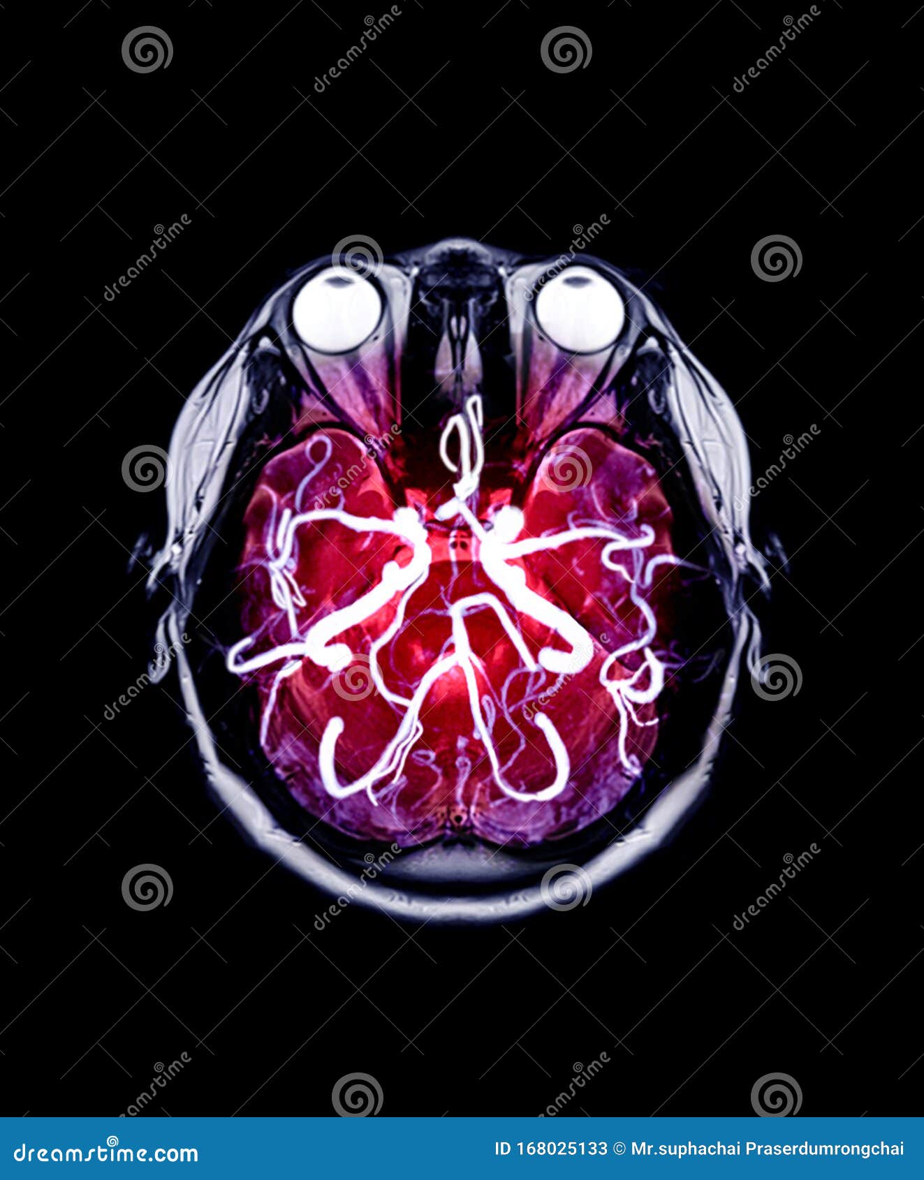 Fusion Image of MRI Brain and MRA Brain. Stock Image - Image of ... Fusion Image of MRI Brain and MRA Brain. Stock Image - Image of ...