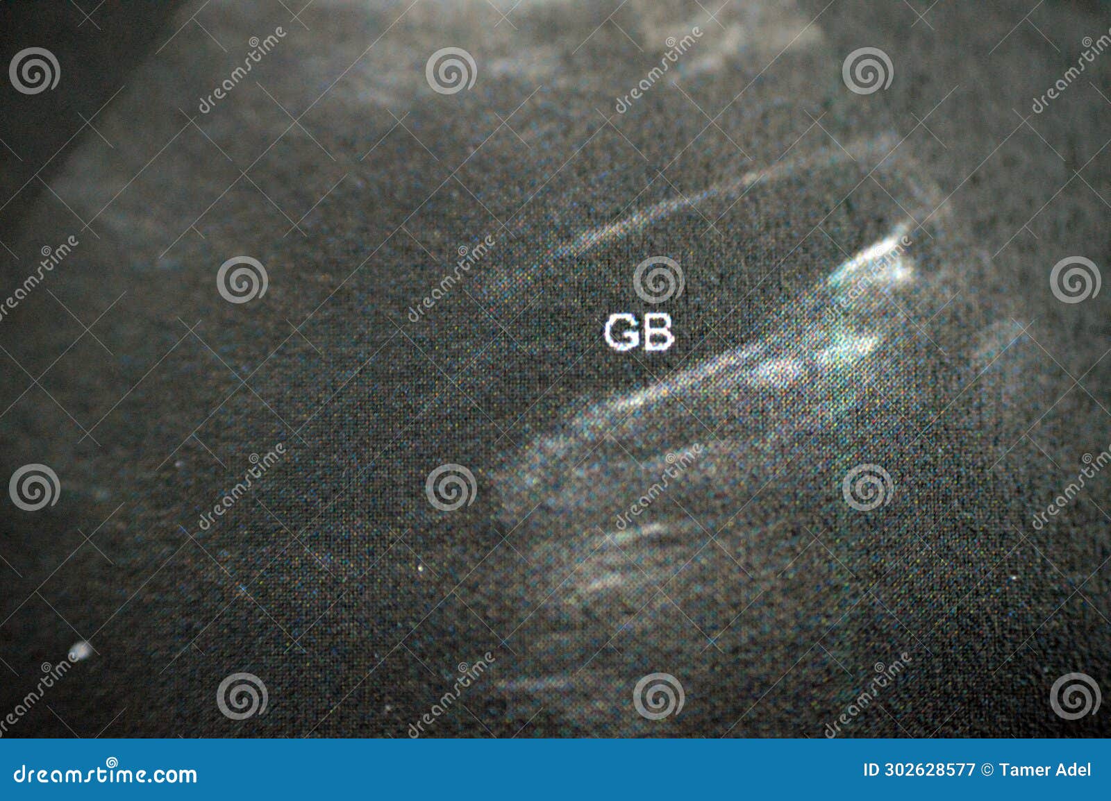 Gall Bladder of Average Size and Normal Wall Thickness, No Stones or ...