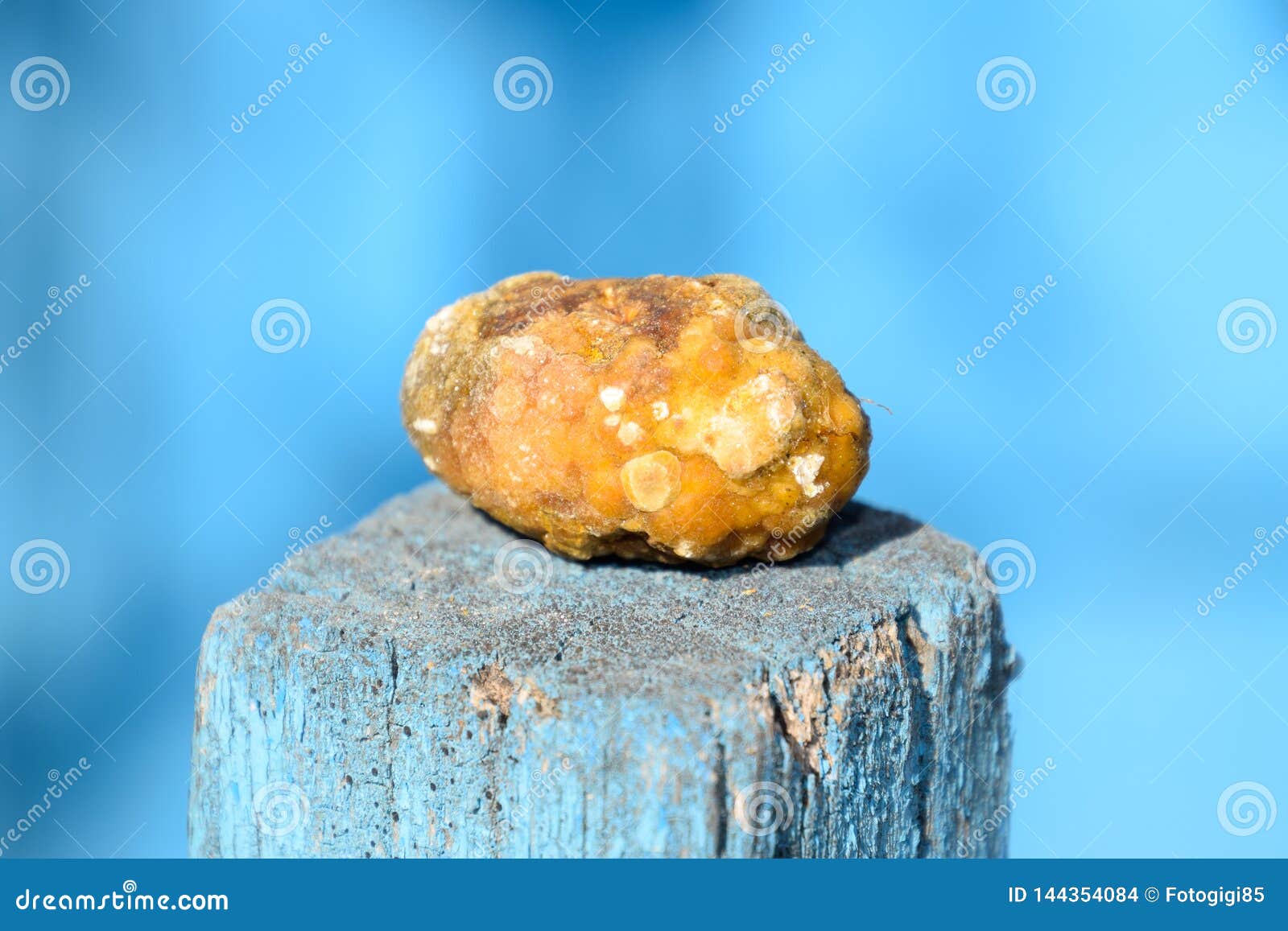 Gall Bladder Stone. Calculus of Heterogeneous Composition Stock Photo ...