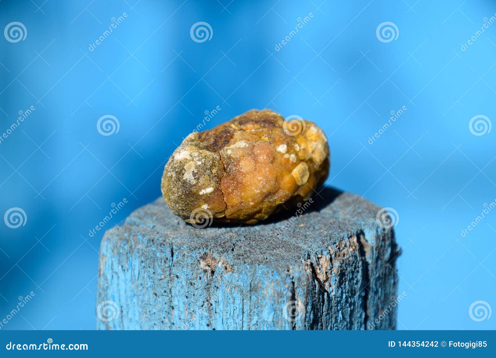 Gall Bladder Stone. Calculus of Heterogeneous Composition Stock Photo ...