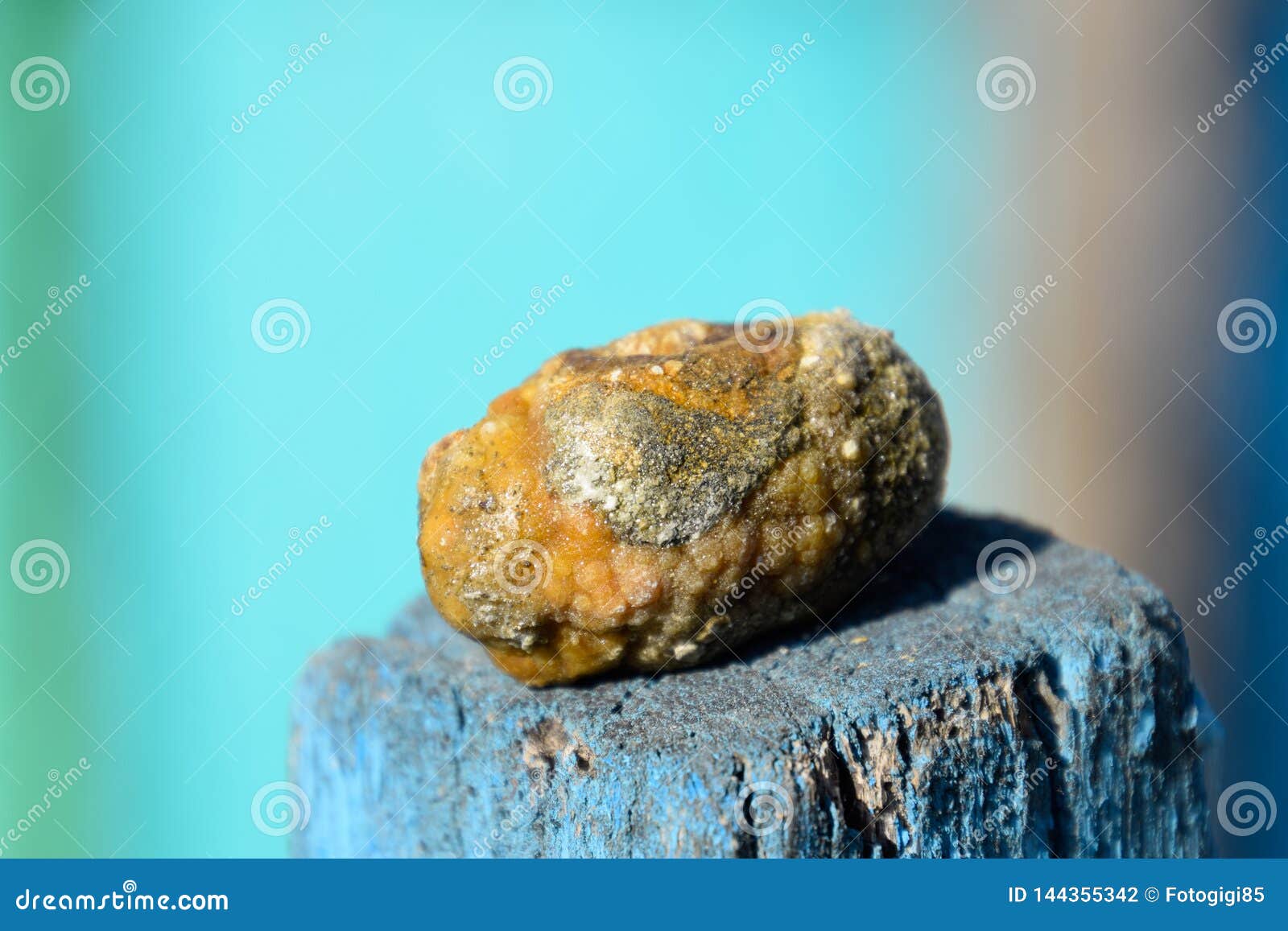 Gall Bladder Stone. Calculus of Heterogeneous Composition Stock Photo ...