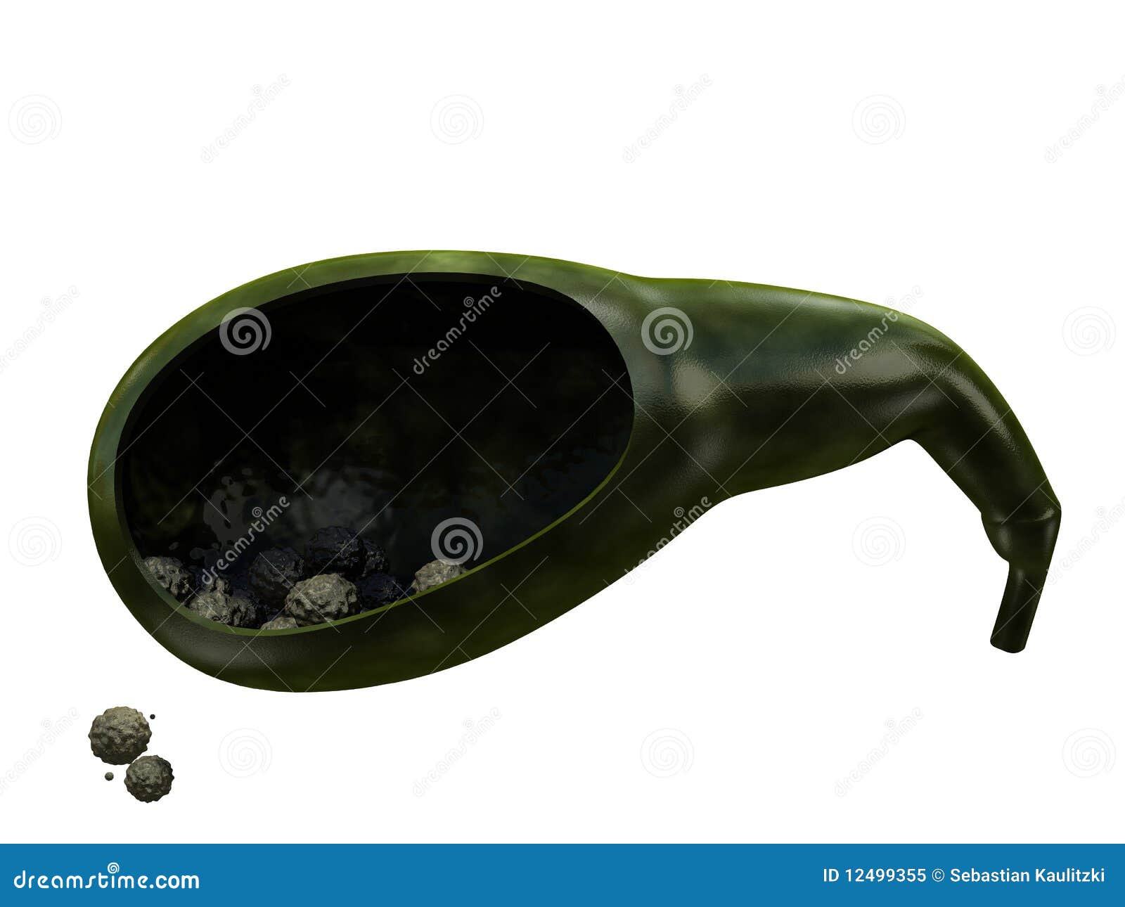 Bladder Stones Cartoon Poster Vector Illustration | CartoonDealer.com ...