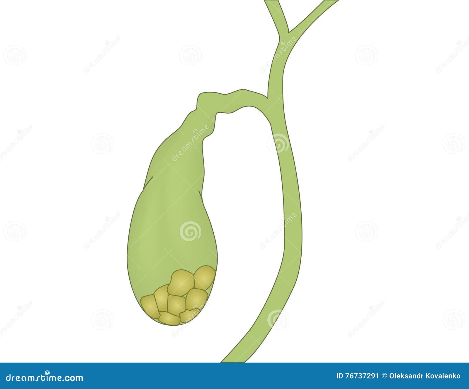 Gall Stone Vector Illustration.Isolated Gallbladder with Stones Stock ...
