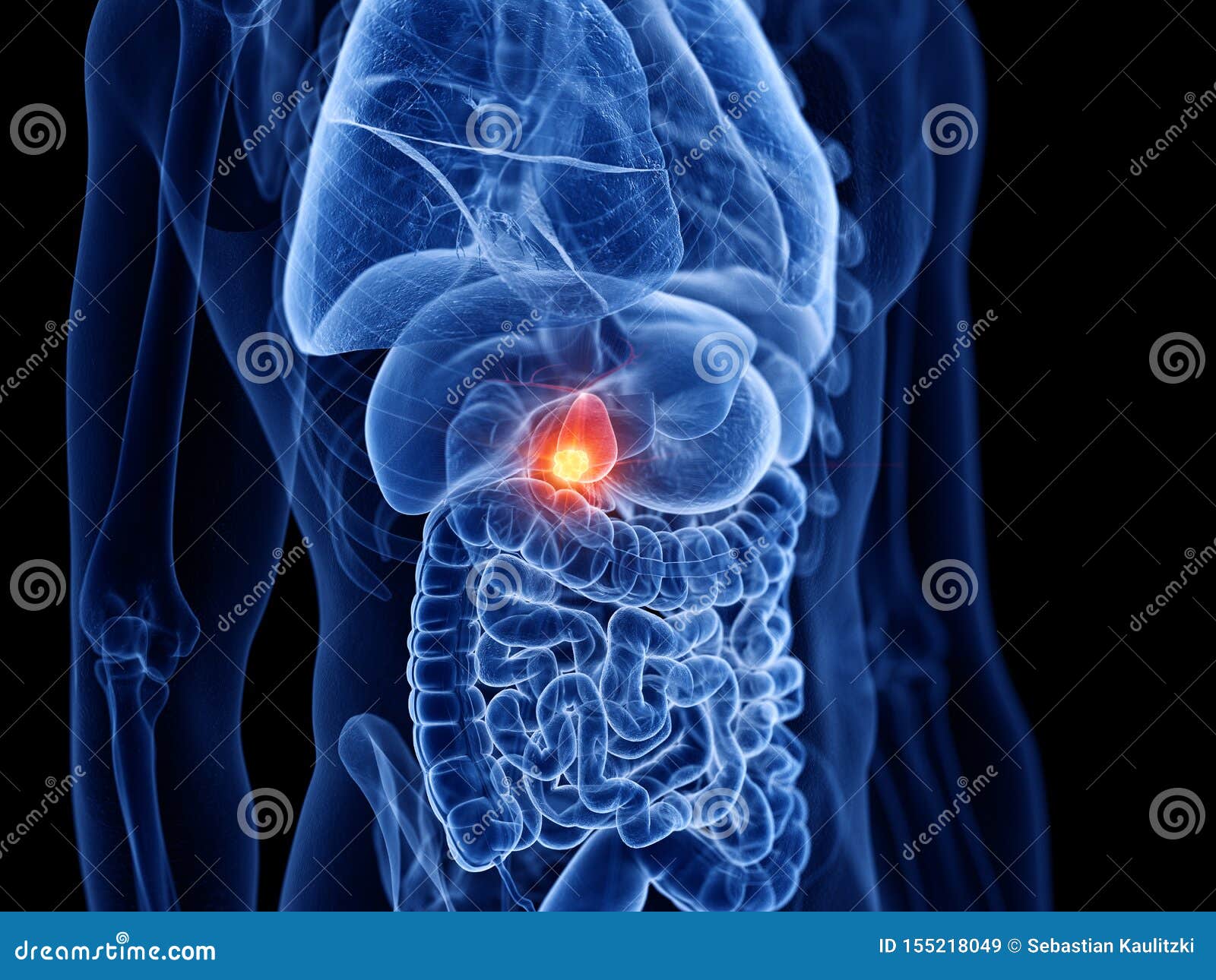 The gallbladder cancer stock illustration. Illustration of graphic ...