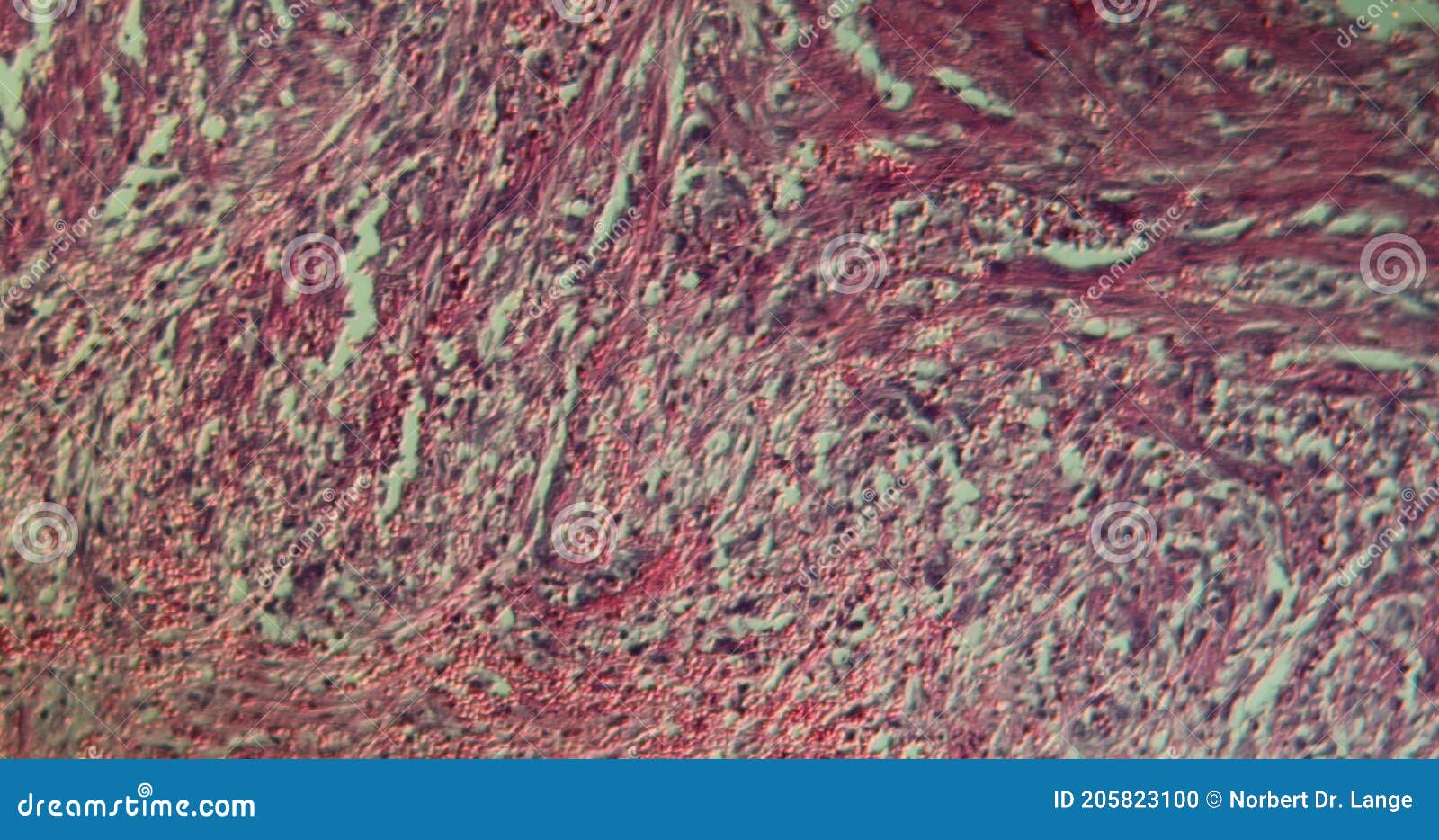 Gallbladder Necrosis Tissue Stock Footage - Video of magnification ...