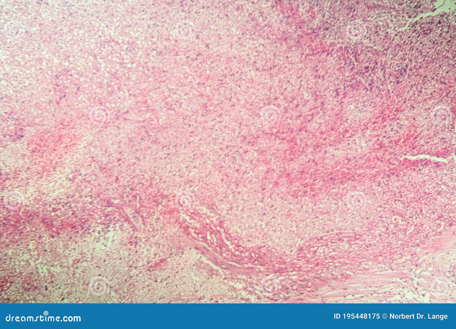 Gallbladder Necrosis Tissue Stock Image - Image of investigation ...