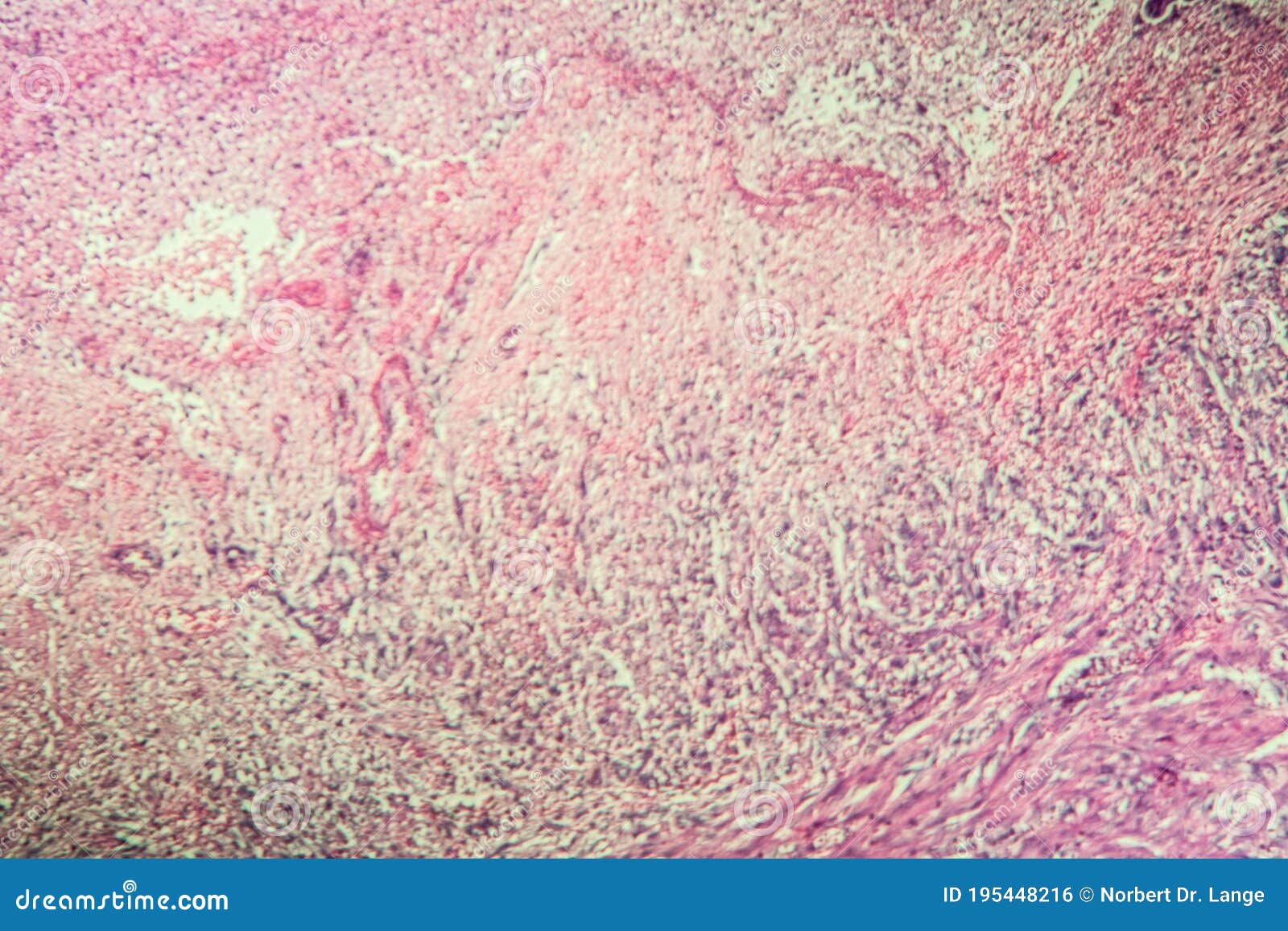 Gallbladder Necrosis Tissue Under the Microscope Stock Photo - Image of ...