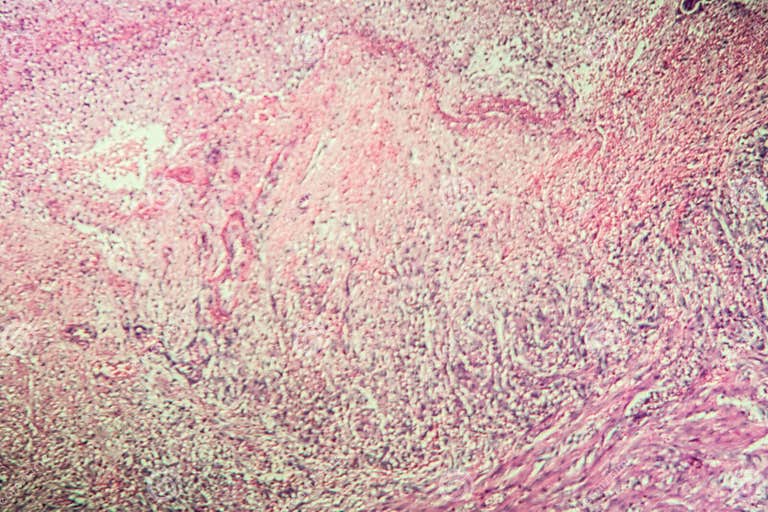 Gallbladder Necrosis Tissue Under the Microscope Stock Photo - Image of ...