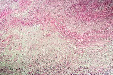 Gallbladder Necrosis Tissue Under the Microscope Stock Photo - Image of ...