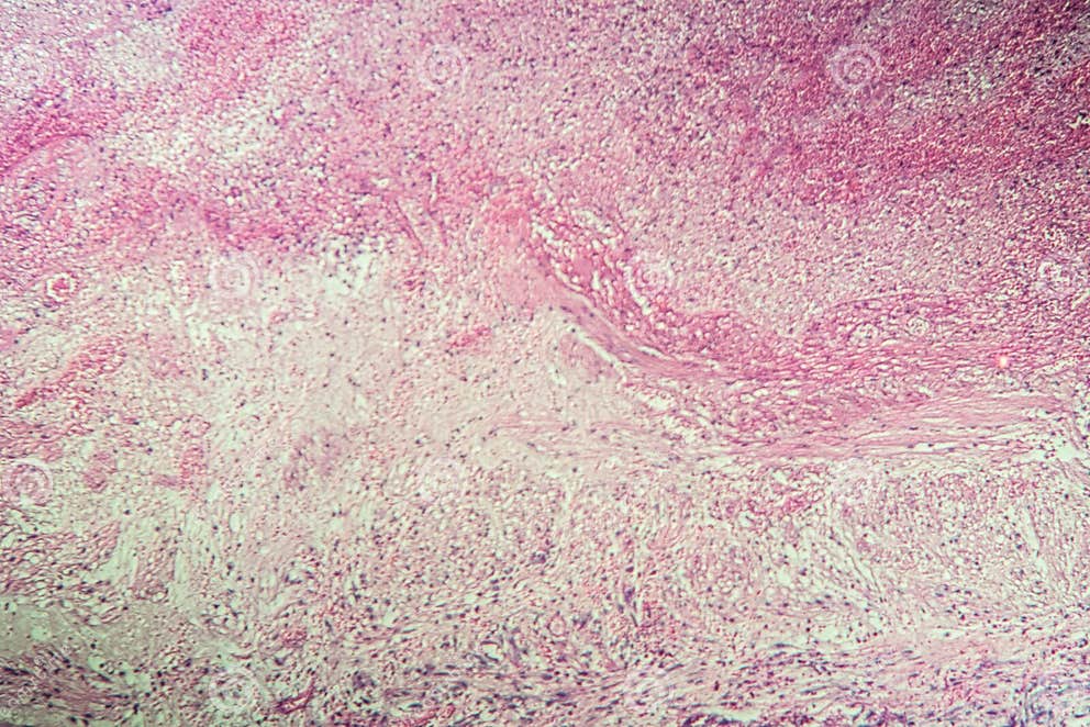 Gallbladder Necrosis Tissue Under the Microscope Stock Photo - Image of ...