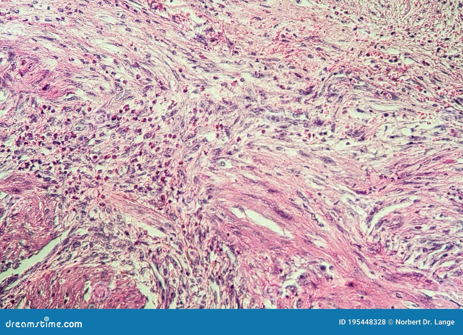 Gallbladder Necrosis Tissue Under the Microscope Stock Photo - Image of ...