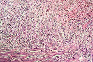 Gallbladder Necrosis Tissue Under the Microscope Stock Photo - Image of ...