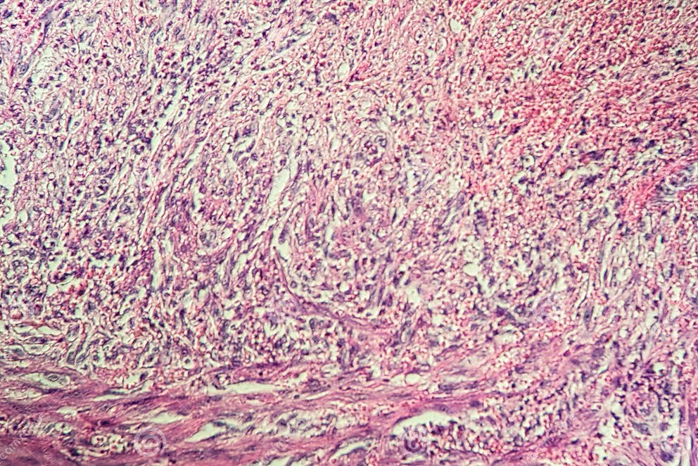 Gallbladder Necrosis Tissue Under the Microscope Stock Photo - Image of ...