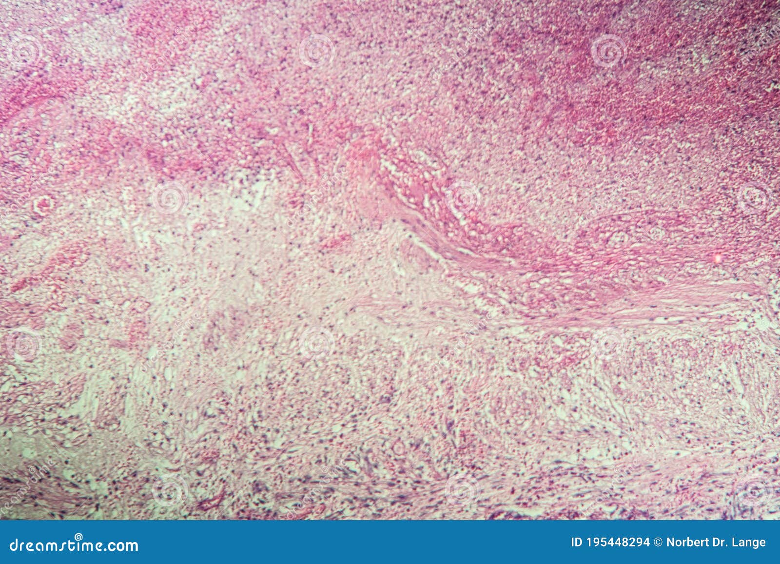 Gallbladder Necrosis Tissue Under The Microscope Stock Photography ...