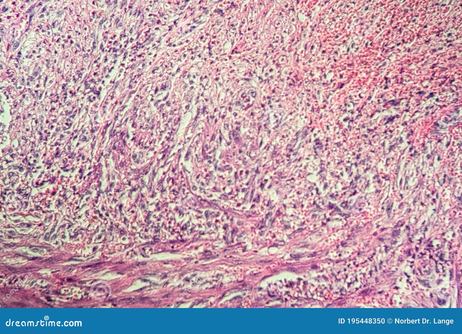 Gallbladder Necrosis Tissue Under The Microscope Stock Photo ...