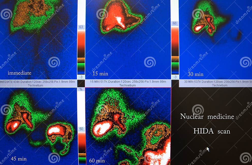 Gallbladder Ejection Fraction Nuclear Scan Stock Image - Image of ...