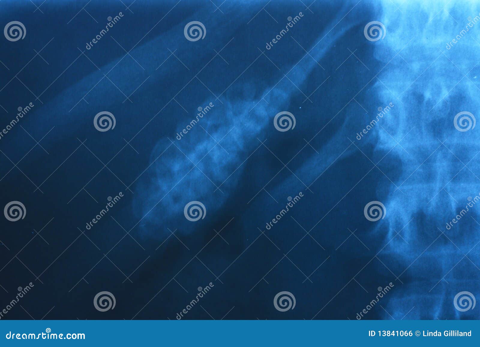 Gallstones stock photo. Image of radiograph, gallstones - 13841066