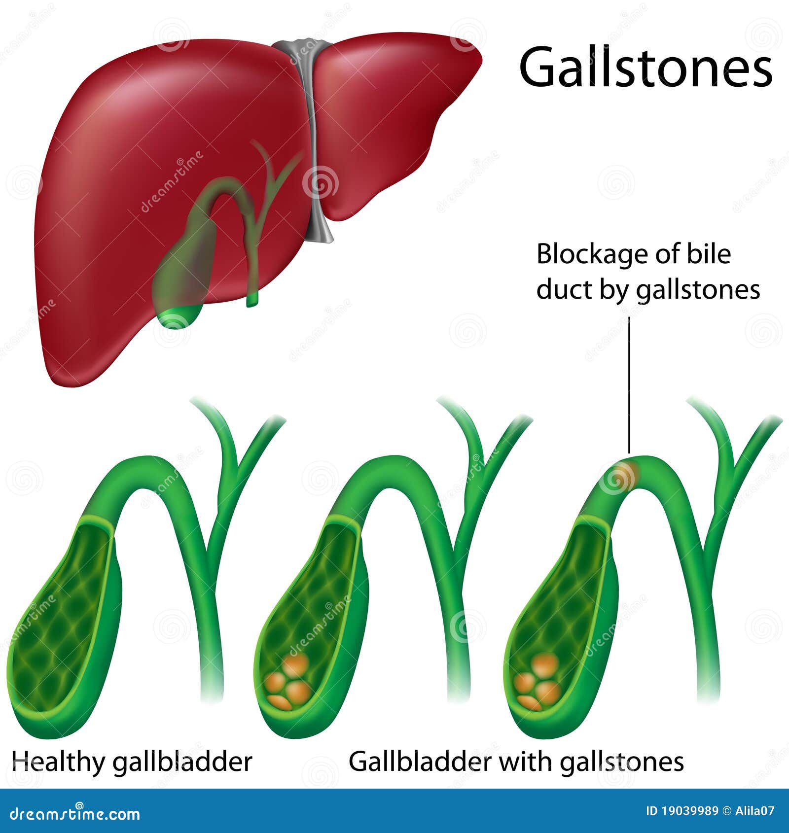 Gallstones stock vector. Illustration of cross, blockage - 19039989