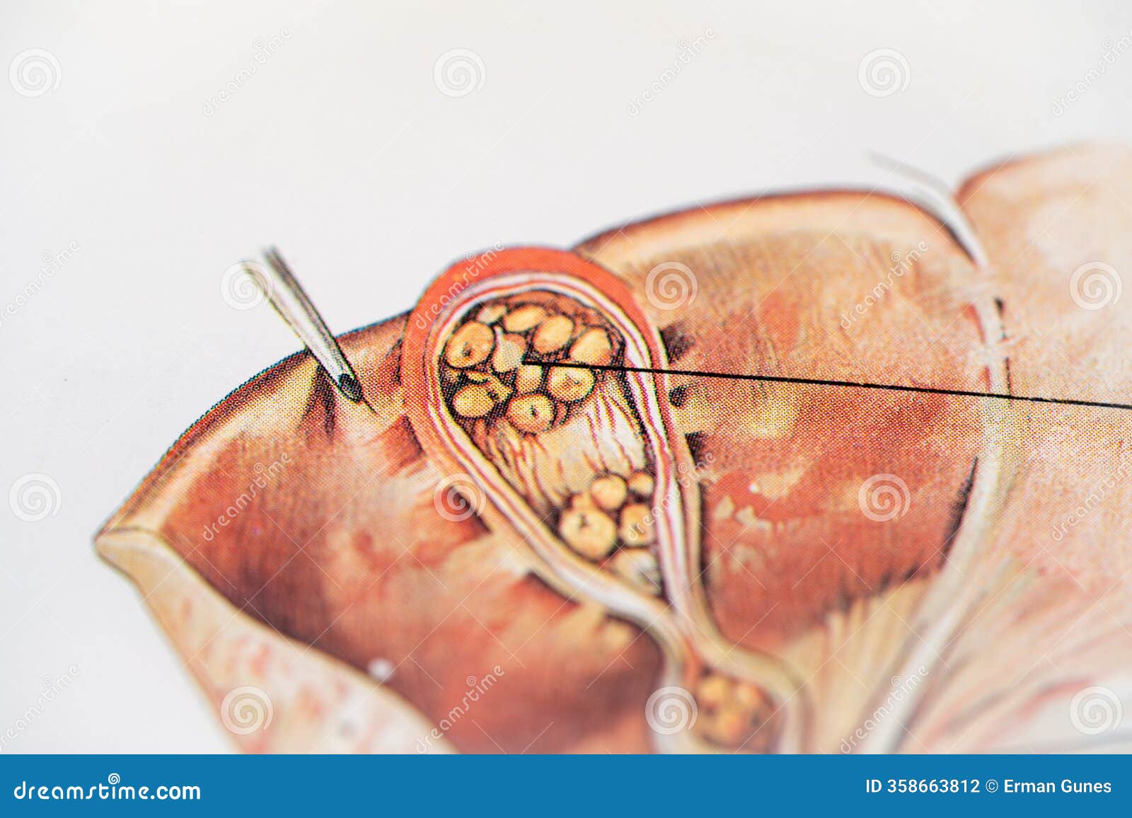 Gallstones in an Anatomical Illustration Stock Photo - Image of system ...