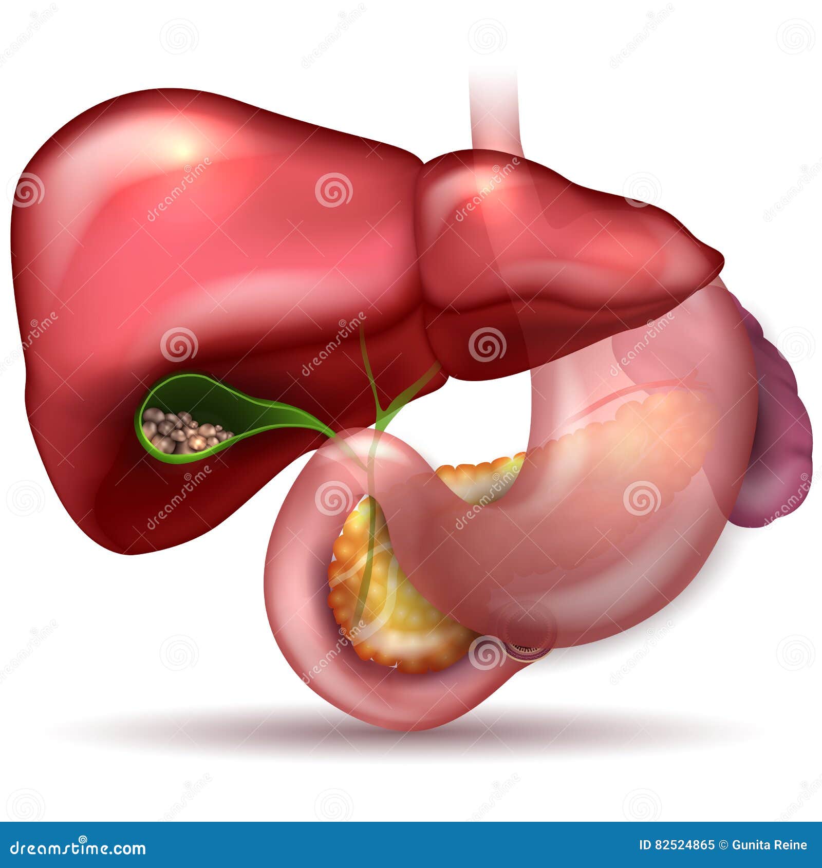 Gallstones Anatomical Cross Section Vector Illustration Diagram With ...