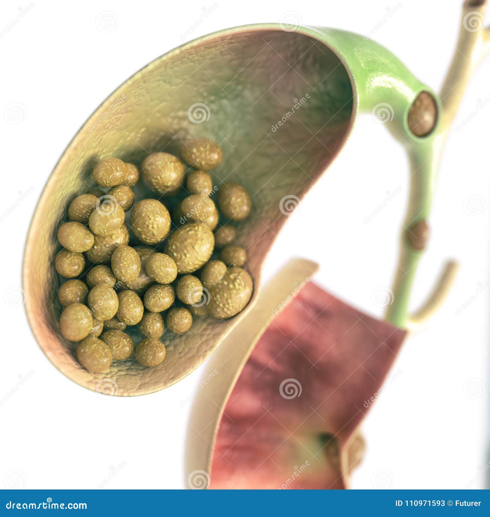 Gallstones in Gallbladder and Bile Duct - High Details - 3D Rendering ...