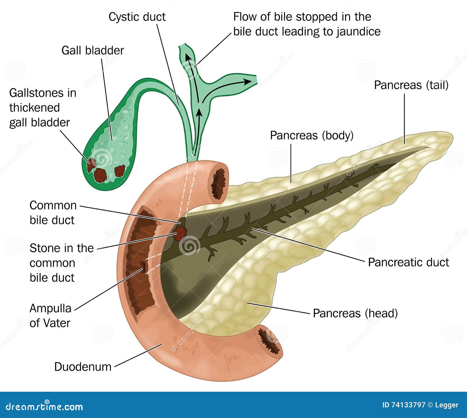 Galstenen in gallbladder stock illustratie. Illustration of blaas ...