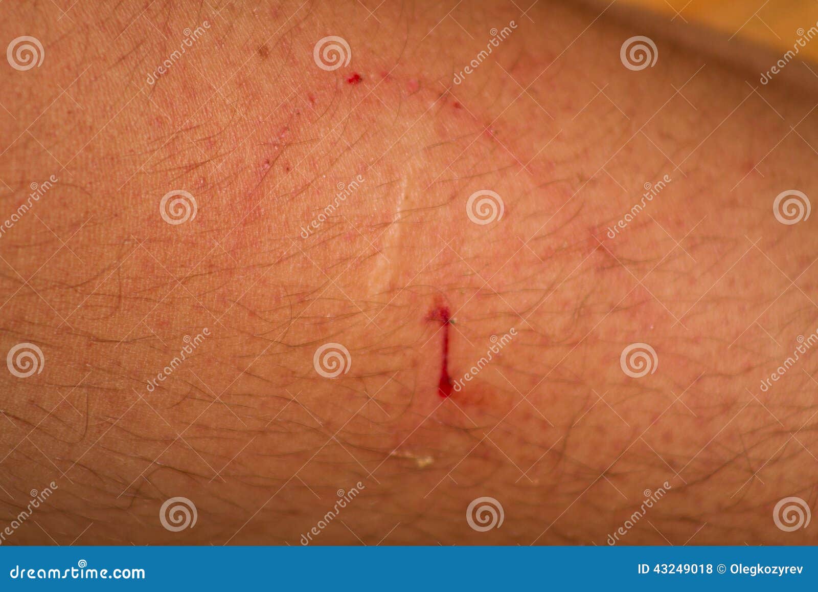 The Gash from the Bite of Dog Stock Photo - Image of hurt, puncture ...