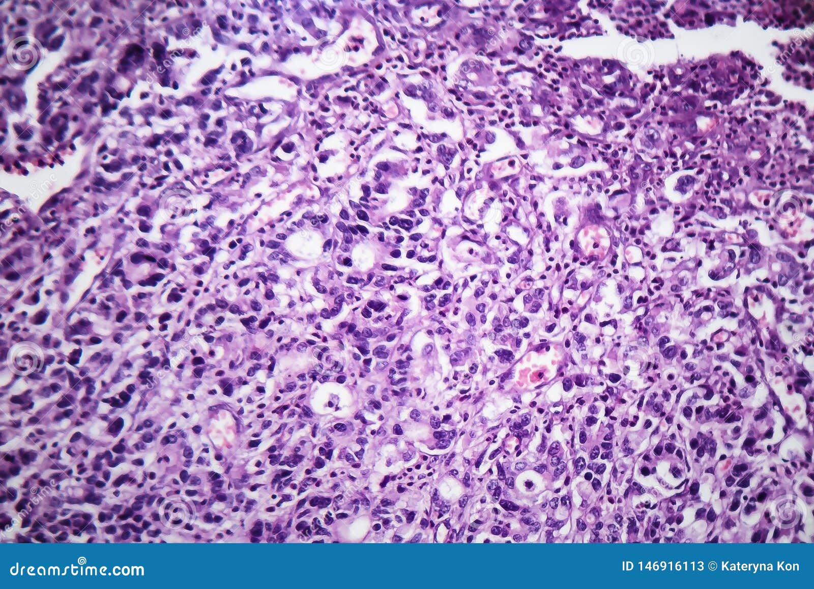 Gastric Adenocarcinoma, Light Micrograph Stock Image - Image of cancer ...