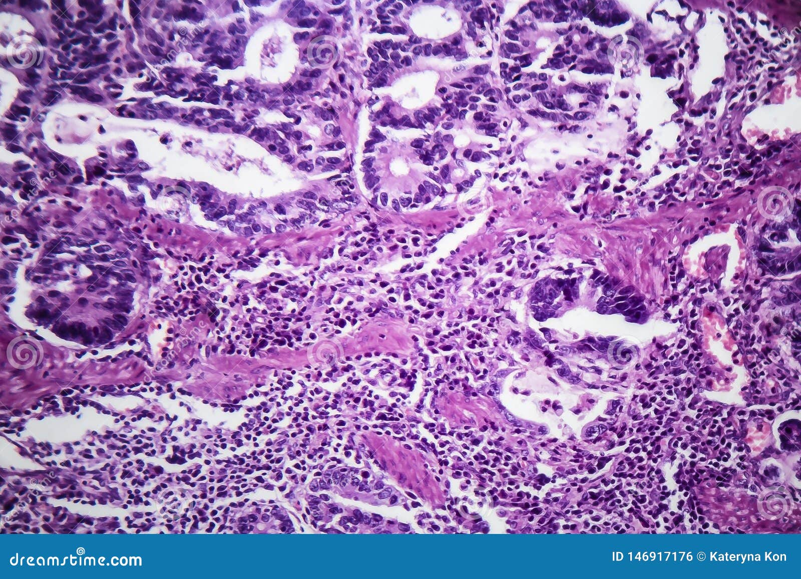 Gastric Adenocarcinoma, Light Micrograph Royalty-Free Stock Photography ...