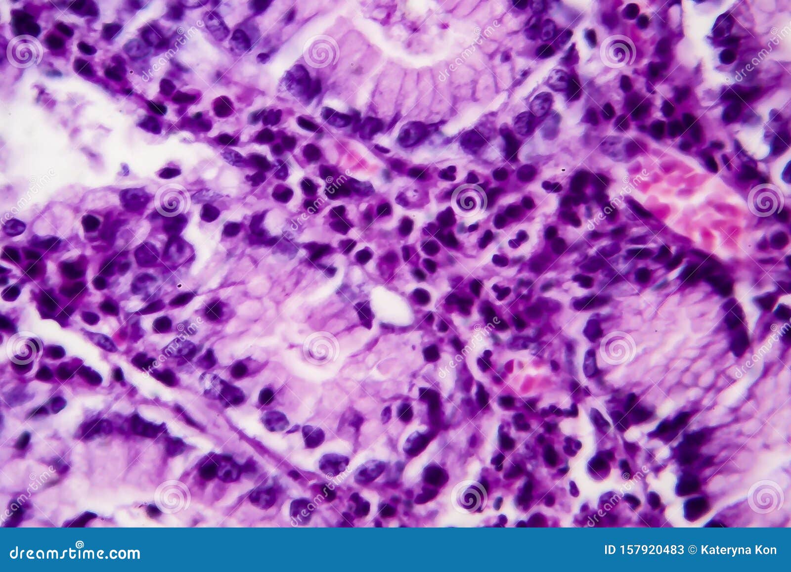 Gastric Adenocarcinoma, Light Micrograph Royalty-Free Stock Photo ...