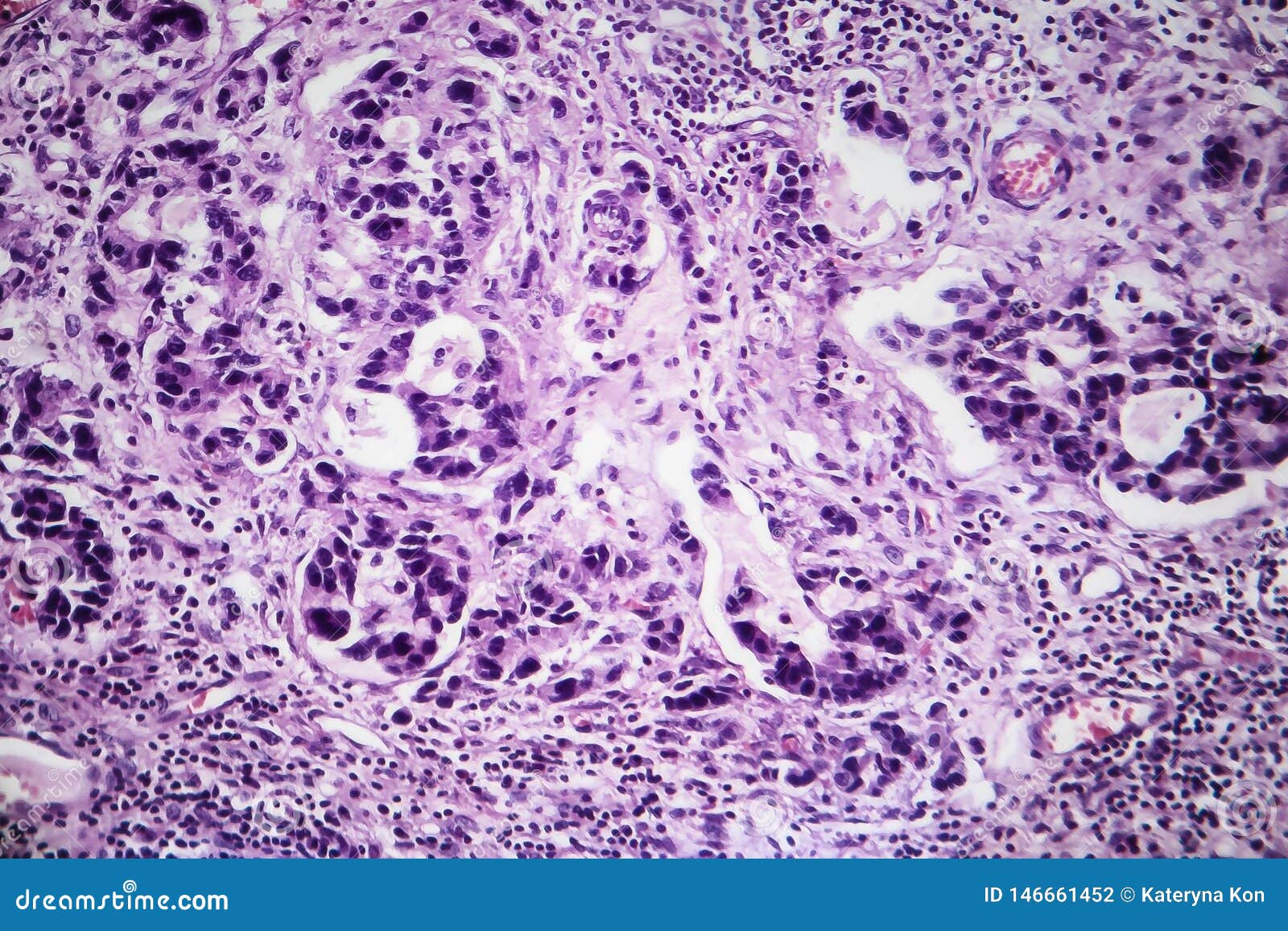 Gastric Adenocarcinoma, Light Micrograph Stock Illustration ...
