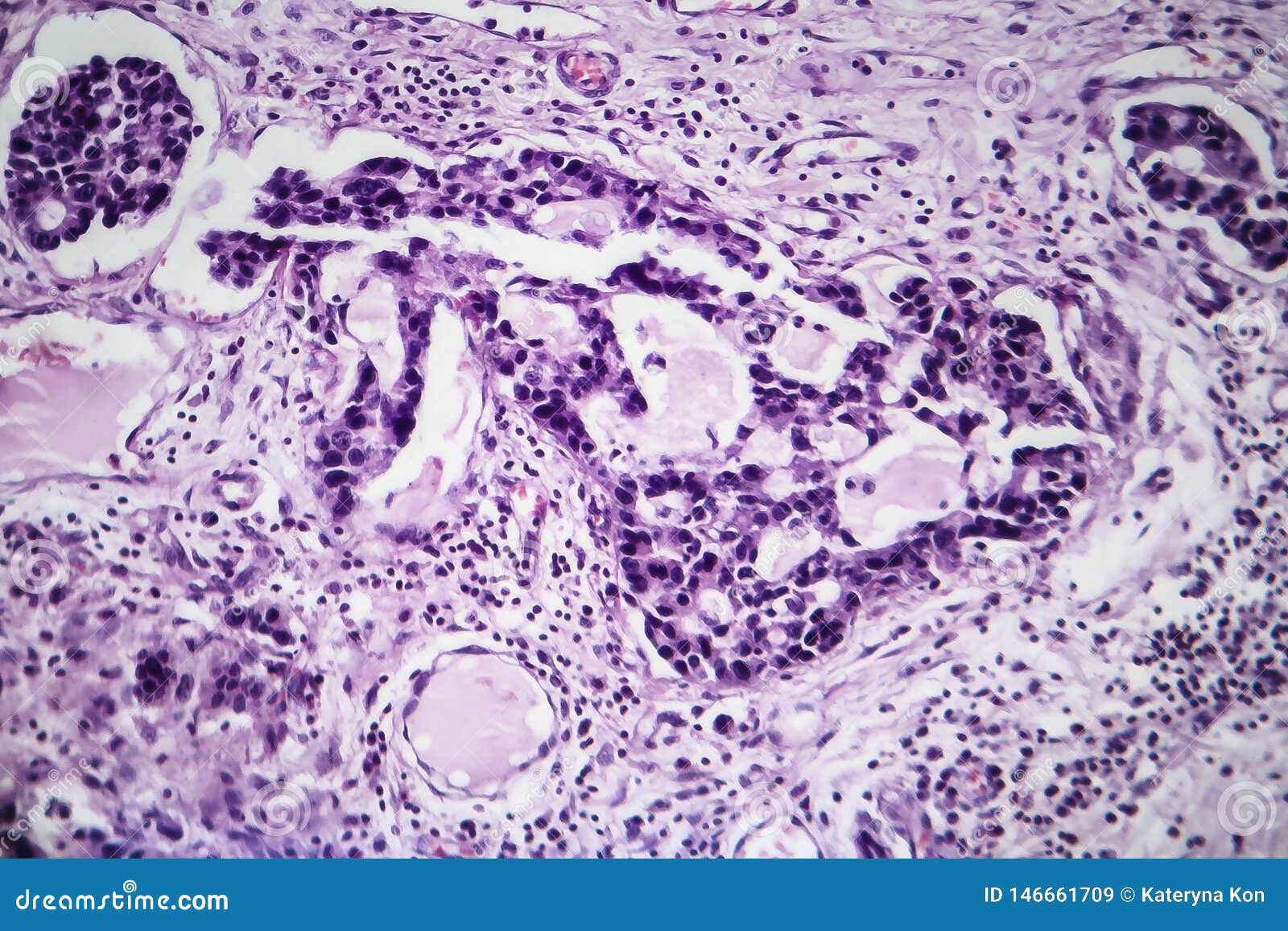 Gastric Adenocarcinoma, Light Micrograph Stock Illustration ...